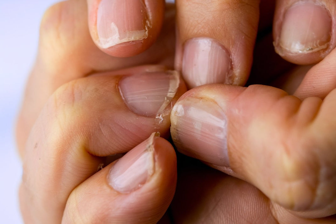 Cracked Nails: Causes, Treatments, and Prevention | Supplend – GL ...