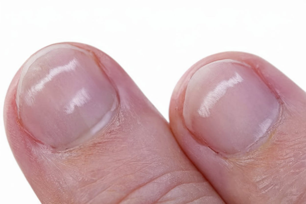 White Spots on Nails: Causes, Treatments & Prevention | Supplend – GL ...